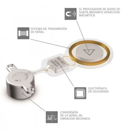 MED-EL presentó en Argentina Bonebridge, el primer sistema de implante ...