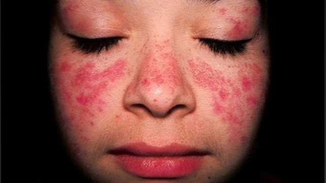 Lupus: Seis datos que hay que saber | Todo en un click